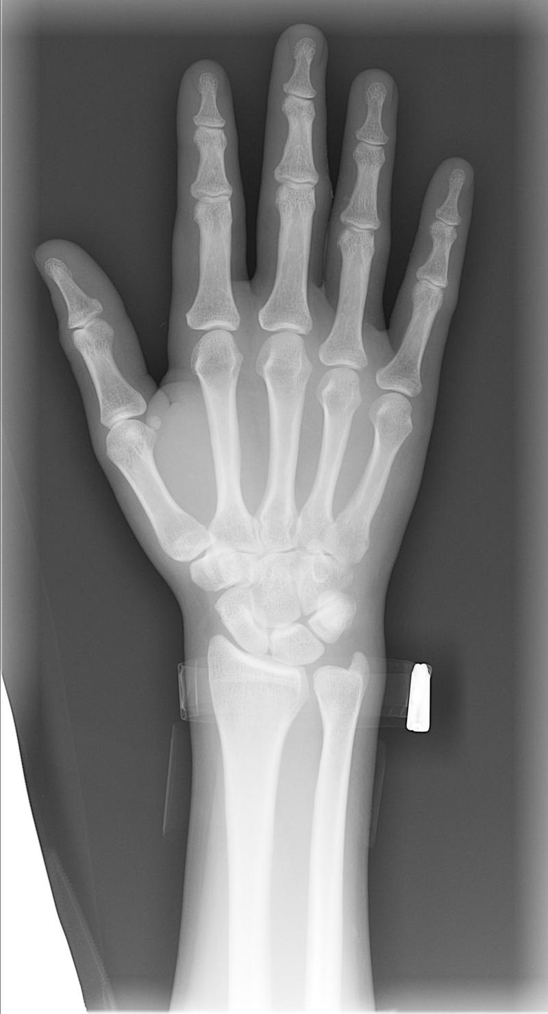My Hand X Ray By Kalany On Deviantart