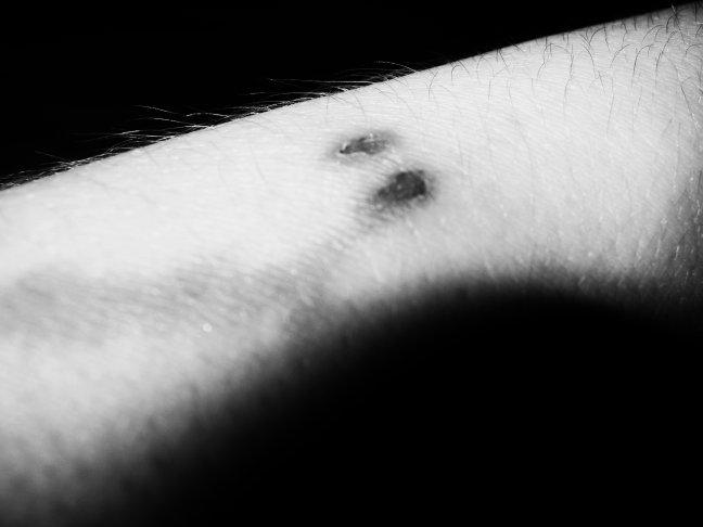 Vampire Bat Bite By Neonhest On Deviantart