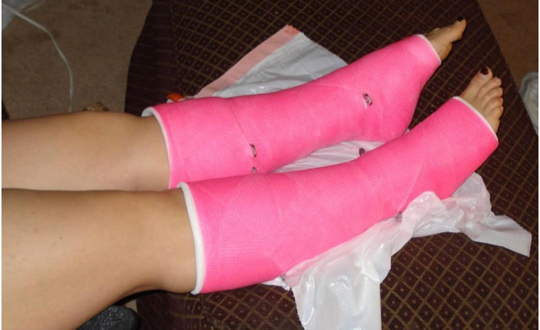 Double Pink Leg Cast By Justafr0g07 On Deviantart