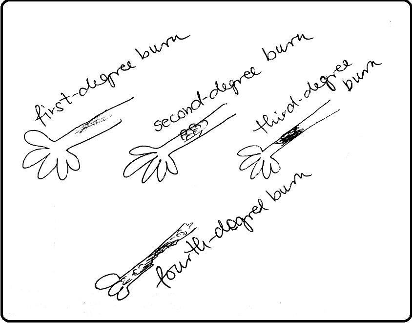 1st 2nd 3rd 4th Degree Burn By Aphorismagician On Deviantart