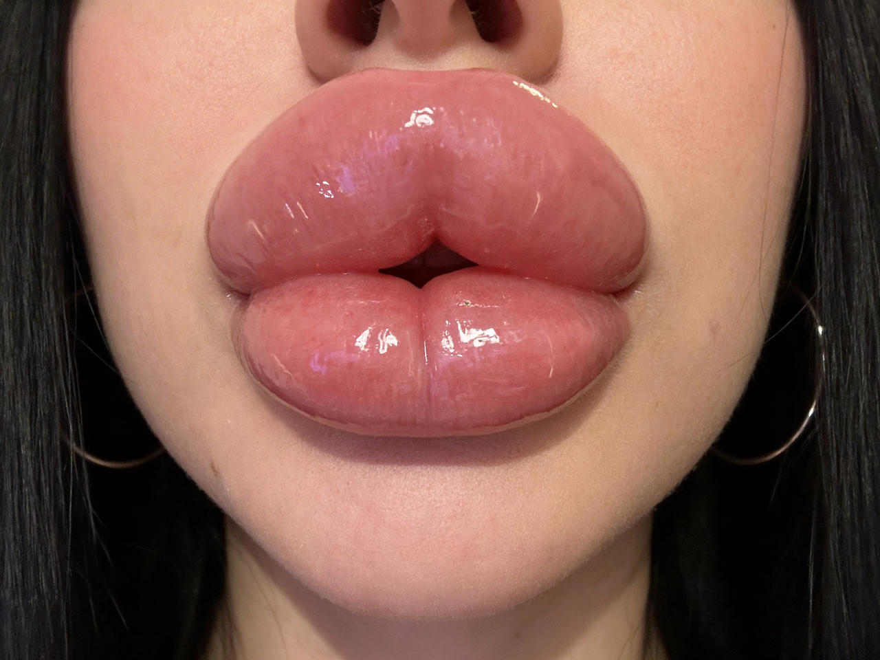 Overfilled Bimbo Lips By Fillerdolls On DeviantArt overfilled-bimbo-lips-by-fillerdolls-on-deviantart