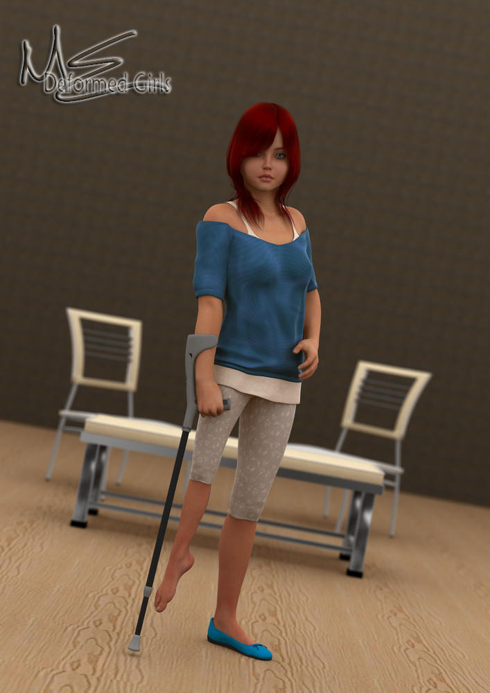 Short Leg Polio Feet by Onefootbare1982 on DeviantArt Short Leg Polio Feet by Onefootbare1982 on DeviantArt